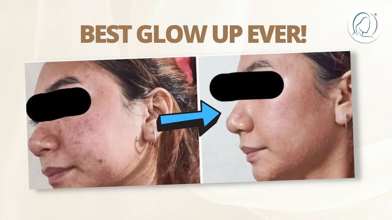 Amazing Derma Roller Transformation! (with BEFORE & AFTER Photo ...