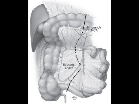 Laparoscopic right hemicolectomy for Ca Cecum with Audio commentary ...