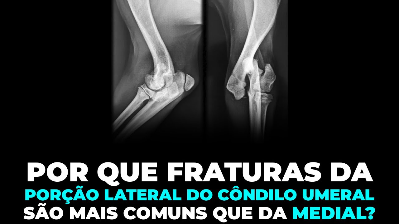 Por que as fraturas da porção lateral do côndilo umeral são mais comuns ...