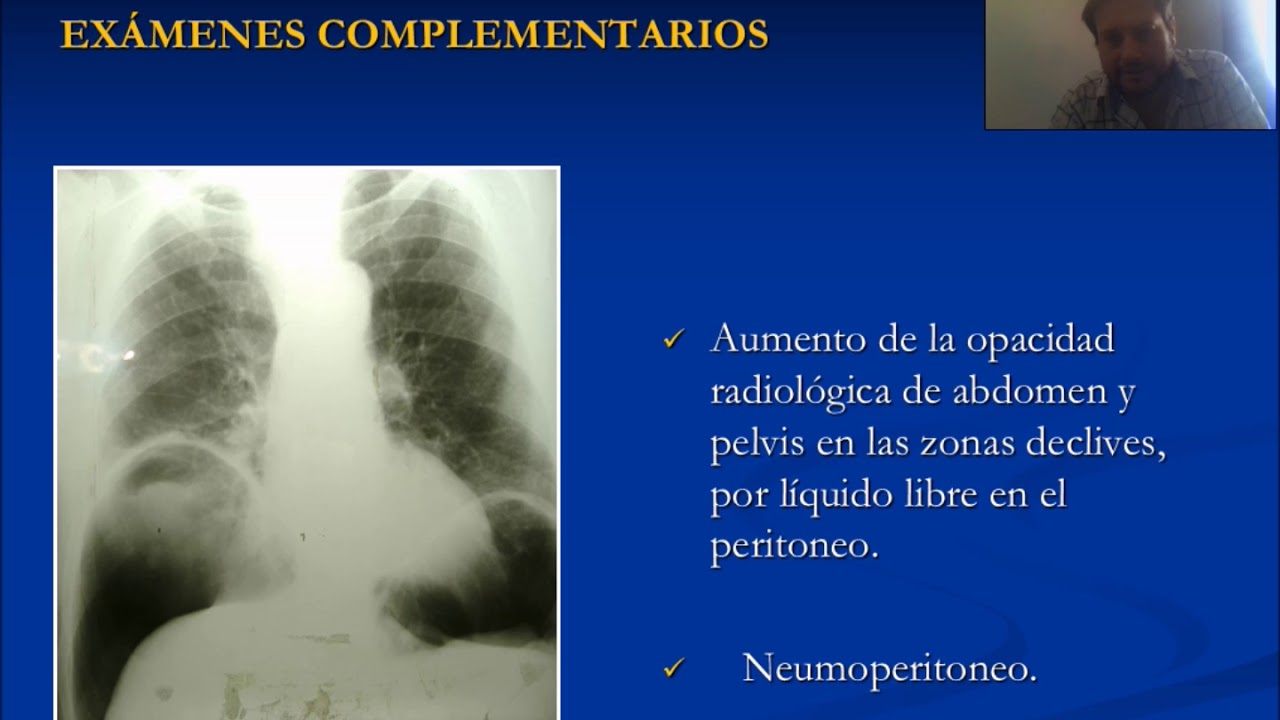 Clínica y tratamiento de la peritonitis aguda - YouTube