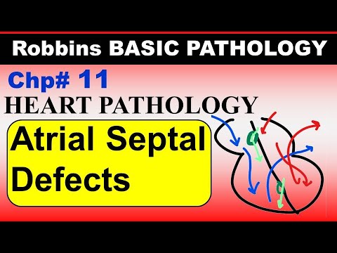 Chp#11 Robbins Patho | Heart Pathology | Atrial Septal Defect | Patent ...
