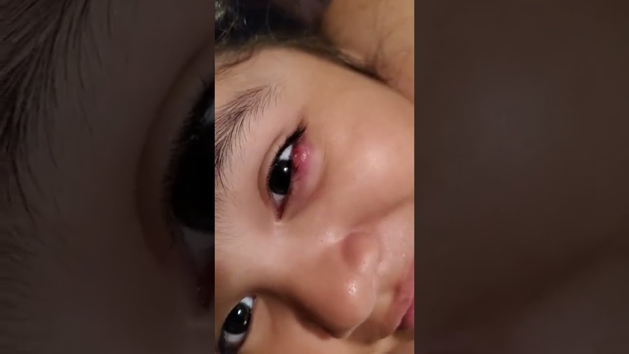 Big Eye Sty popping eye hurts, can go blind, do not try this at home go ...
