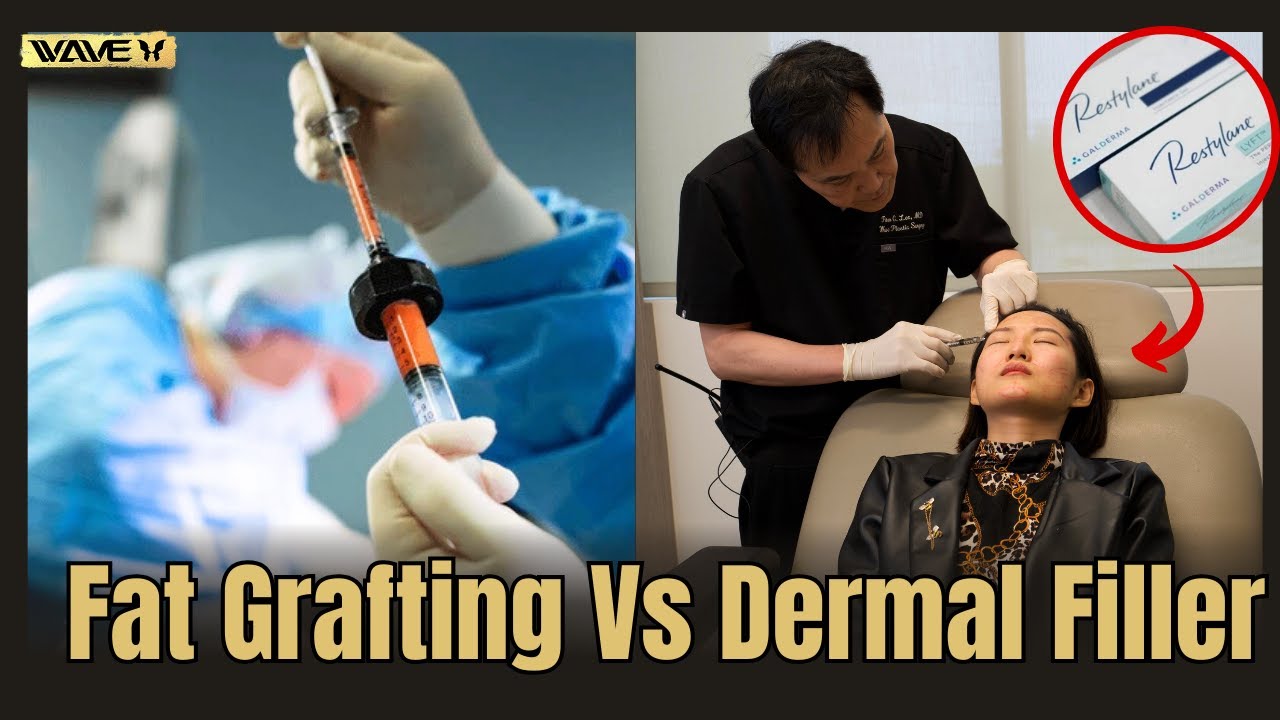 Fat Grafting vs. Fillers: Which is Right for You? - YouTube