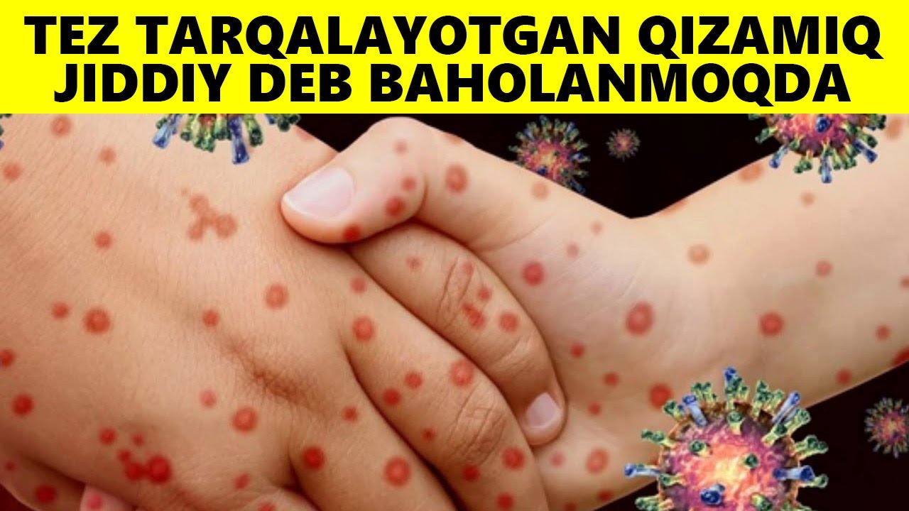 Tezkor Xabar: Tezlik Bilan Tarqalayotgan Qizamiq Jiddiy Deb ...