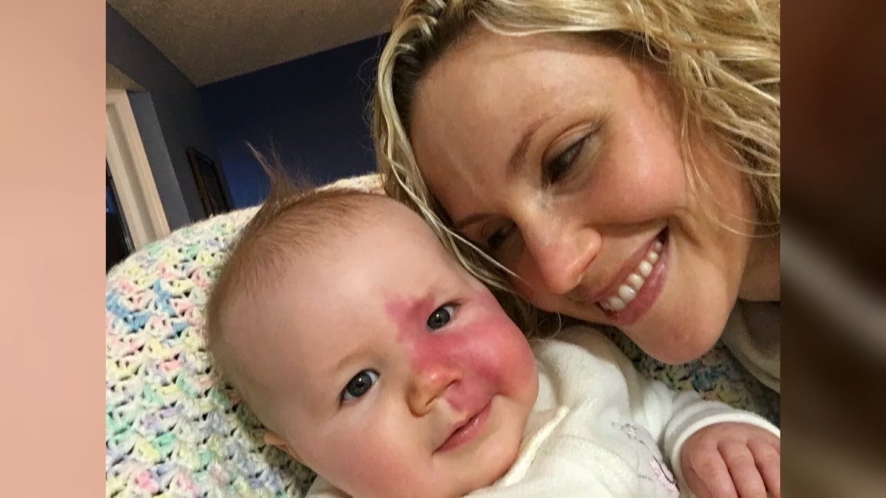 Celebrating a Birthmark Bond: Elizabeth Klinge Shares Daughter's Story ...