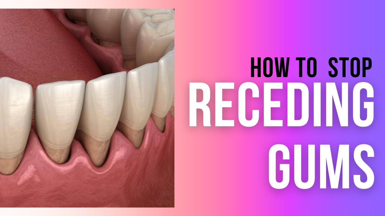 What Causes Gum Recession and How To Stop It'- [Holistic Dentist ...