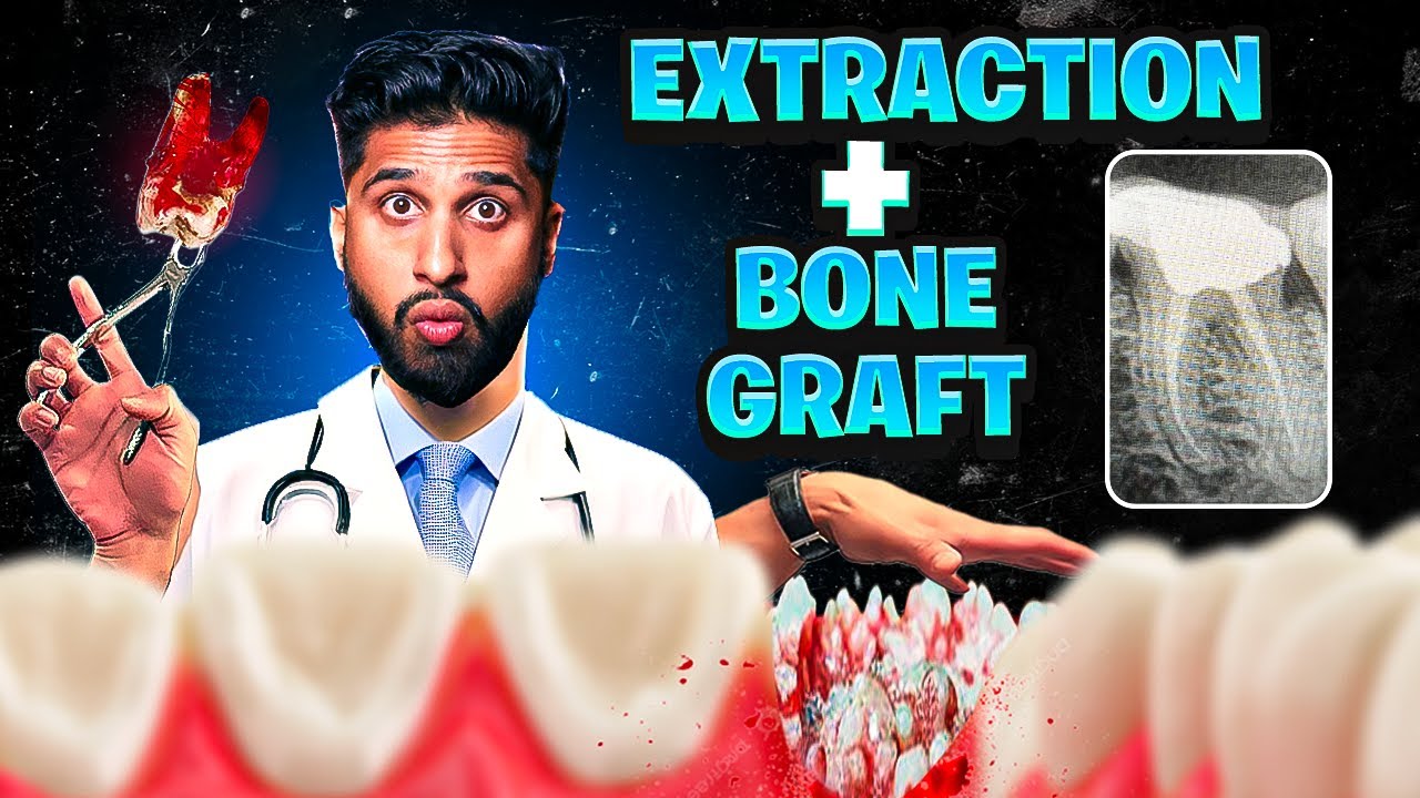 Tooth Extraction and Bone Graft for Dental Implants (Tools, Sectioning ...