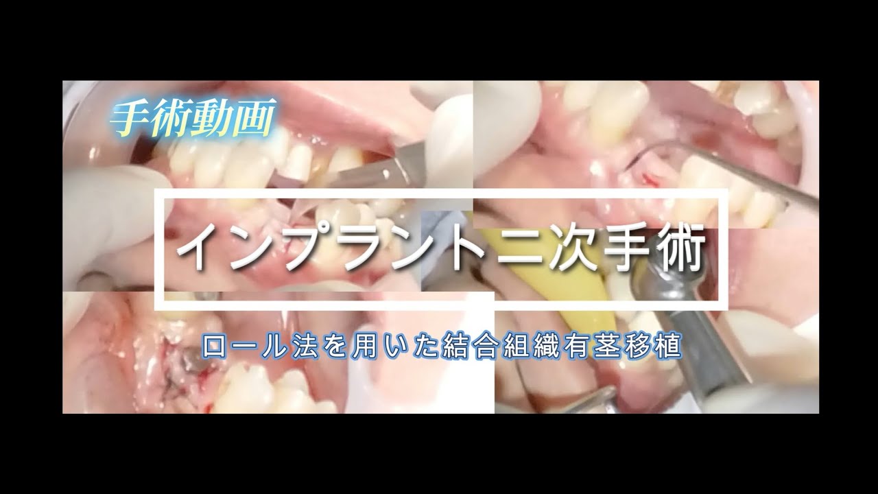 【手術動画】インプラント二次手術（ロール法）/Second-Stage Implant Surgery Using the Roll ...