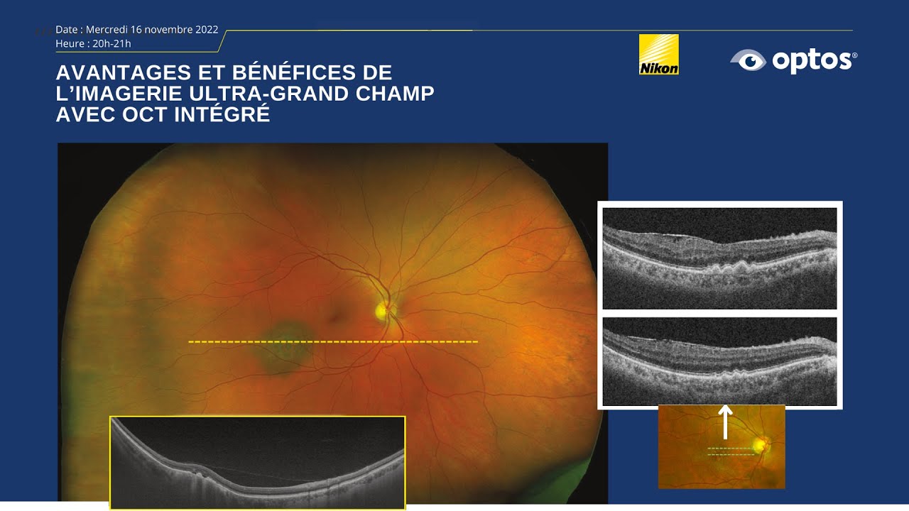 Webinar: Advantages & benefits of ultra-wide field imaging with ...