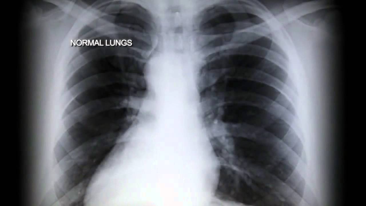 Losing Breath - The Adam Sager Story - YouTube