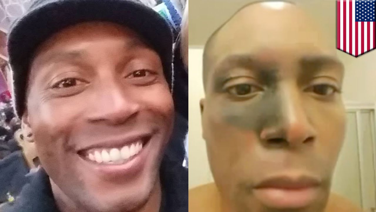 E-cig explosion: Vape pen burns and and permanently scars Air Force ...