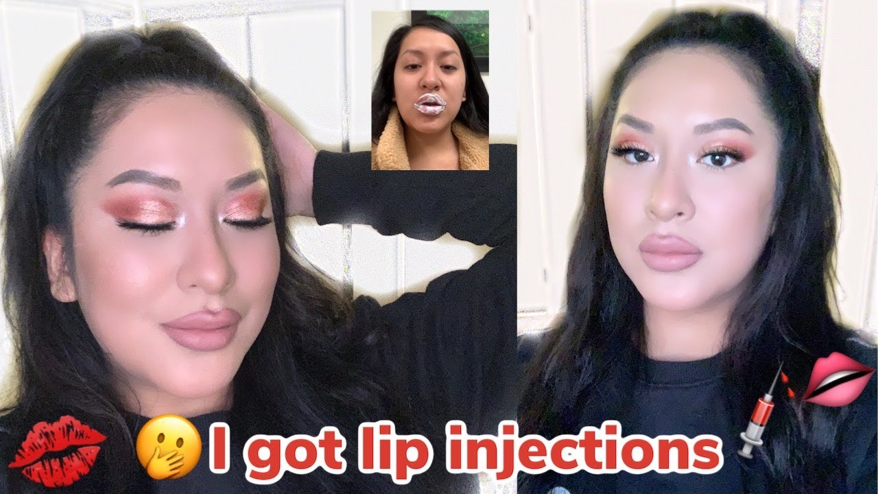 My lip injection experience - YouTube