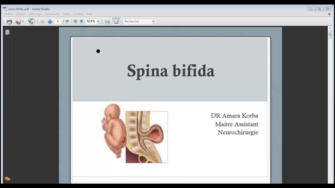 SPINA BIFIDA. DR AMARA KORBA - YouTube
