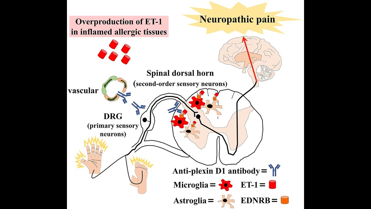 Neuropathic Pain Or Nerve Pain ; Definition, Causes, Symptoms ...