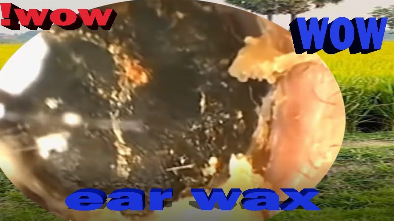 Huge Tonsil Stones Ear wax Removal in a case of Chronic Tonsillitis ...