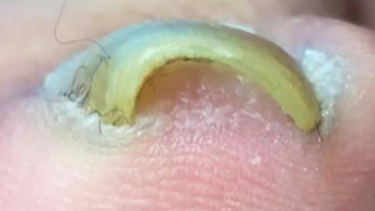 Long And Curly Ingrown Toenails, Clean Up Dead Skin【Crazy pedicure room ...