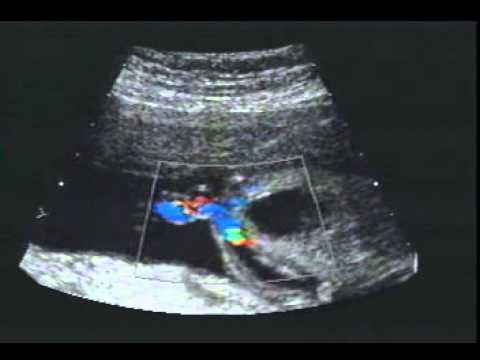 2 VESSEL CORD - YouTube