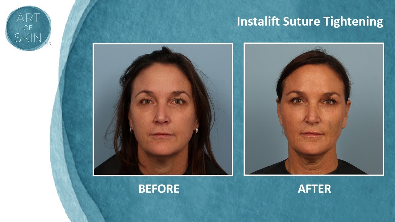 Instalift silhouette facelift suture tightening San Diego - YouTube