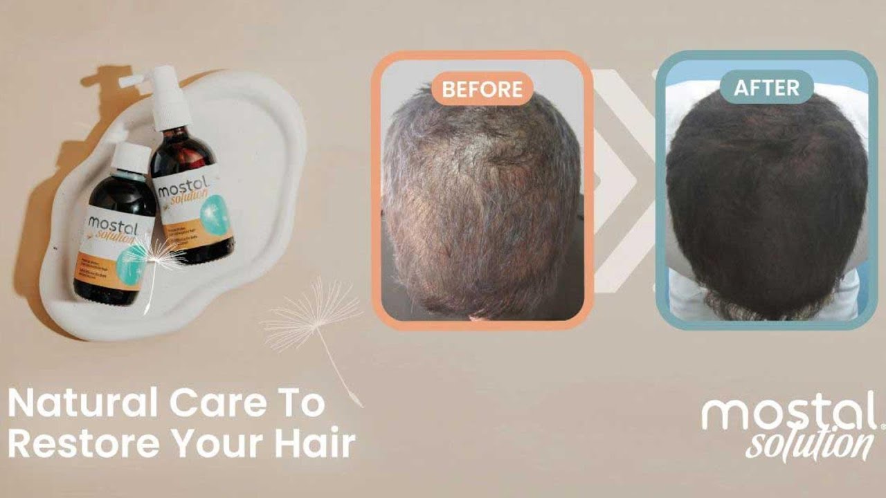 Say Goodbye to Hair Loss with Mostal Hair Solution | Mostal Hair ...
