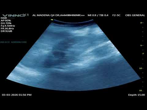 ABDOMEN : LEFT LOIN PAIN  ( SMALL LEFT URETERIC STONE) 2026 03 03 13 49