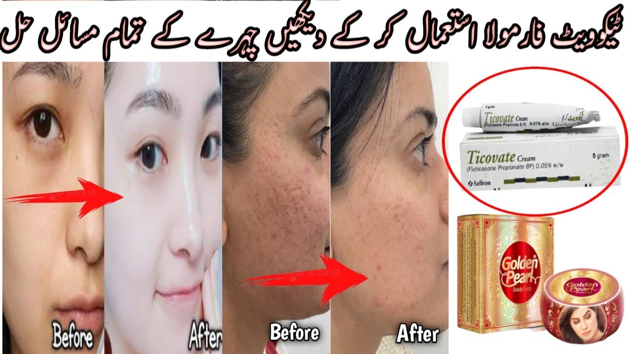 Whitening formula with ticovate cream for all type of skin instant ...