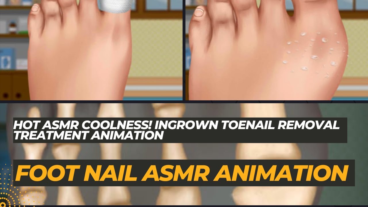 Hot ASMR Coolness! Ingrown Toenail removal treatment animation - YouTube