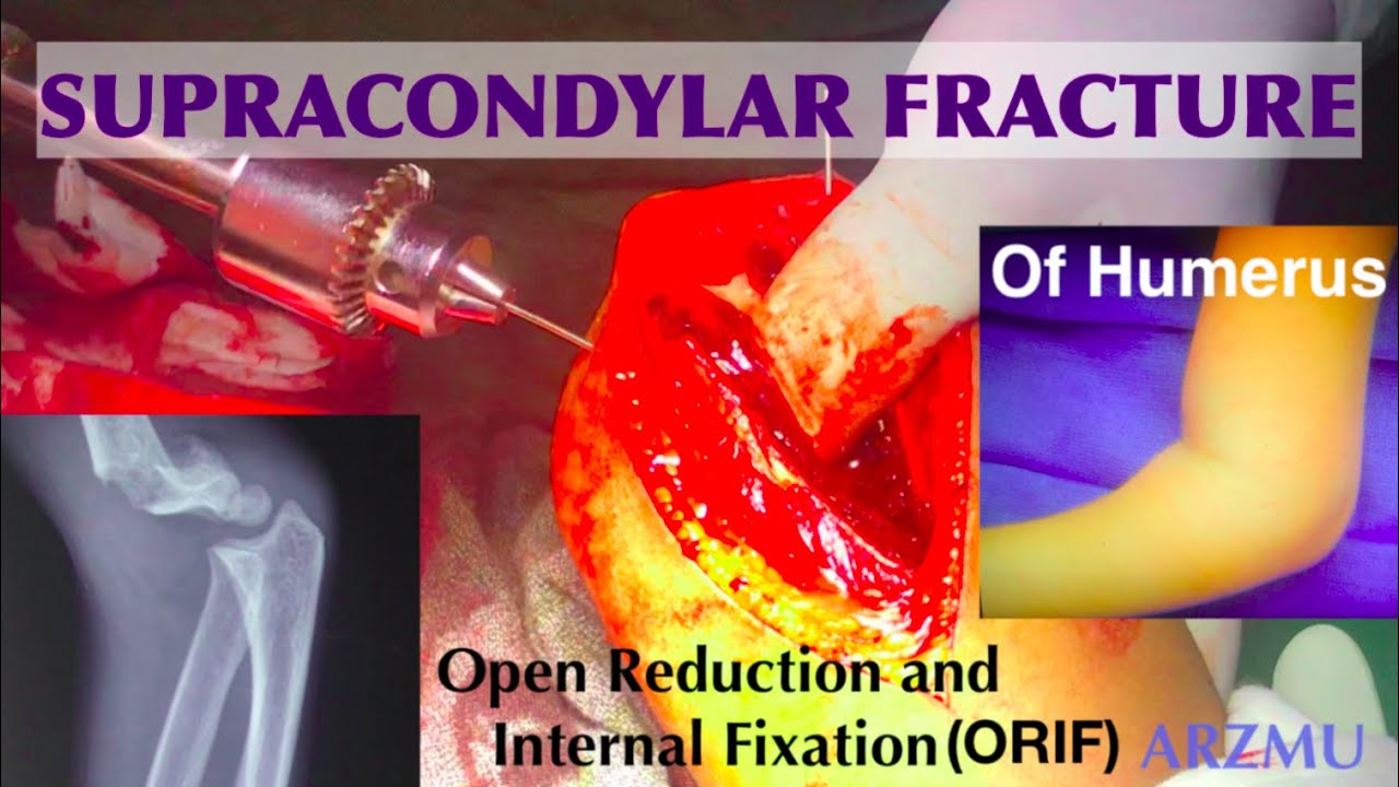 Supracondylar Fracture of the Humerus | Open Reduction and Internal ...