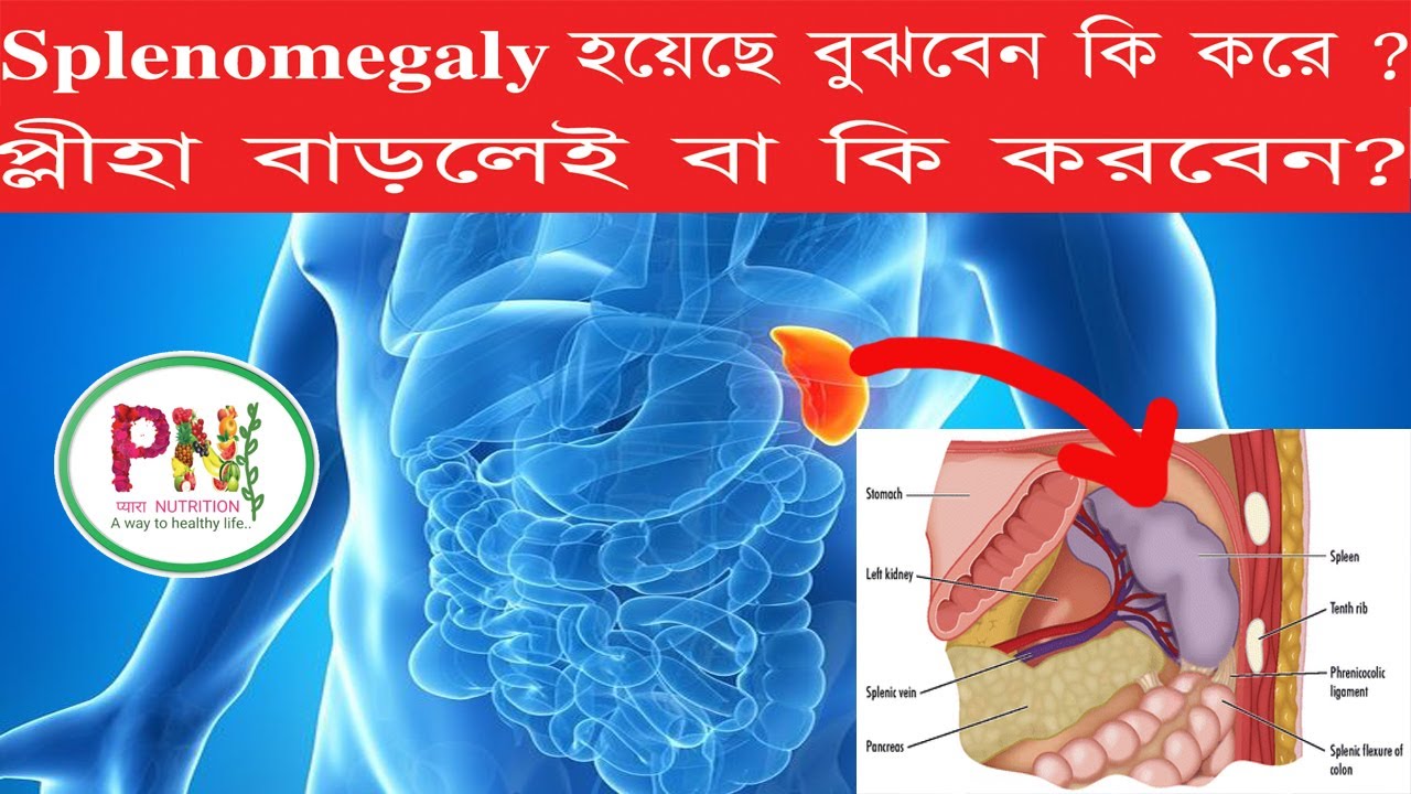Splenomegaly Causes Symptoms Diet || প্লীহা বাড়লে কি করবেন || - YouTube