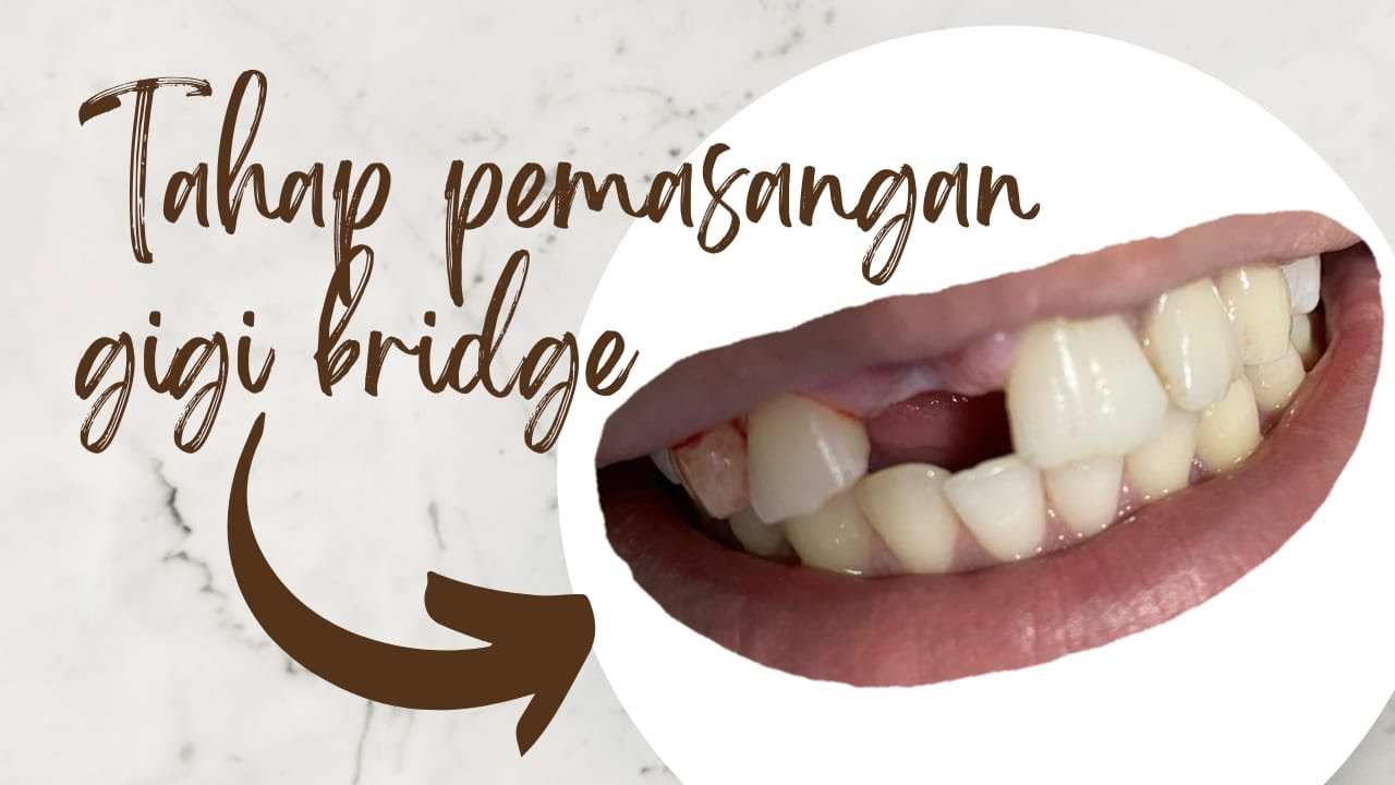 Pemasangan Jembatan Gigi/ Bridge / by.Dokter Tri Yatmi Putri - YouTube