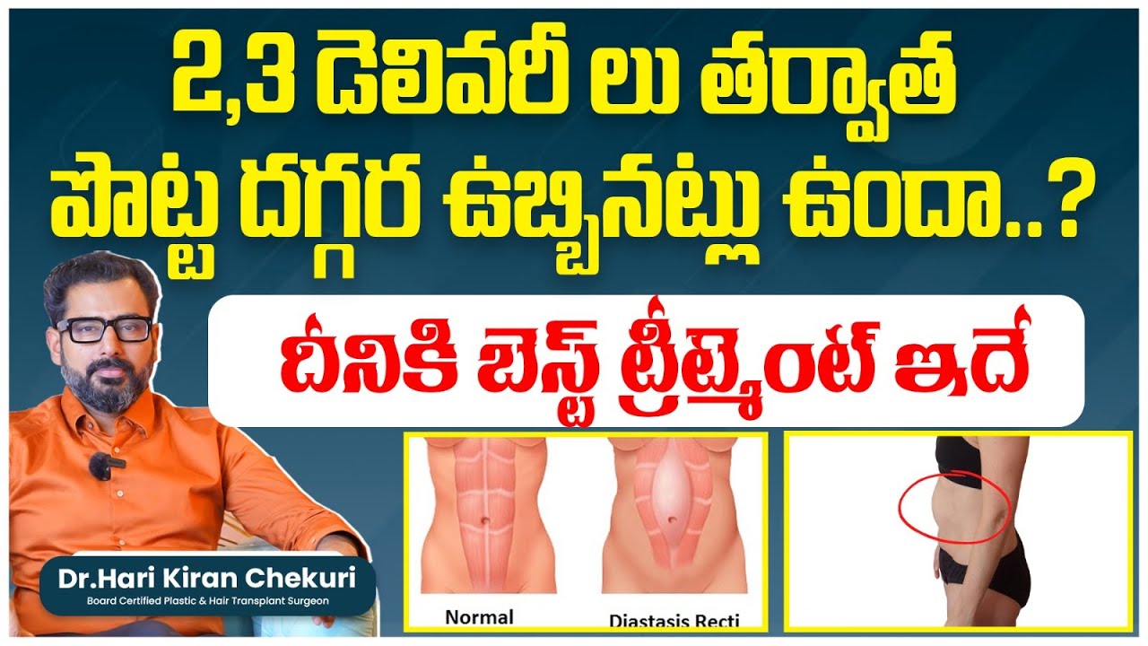 Divarication of Recti Explained | Causes, Symptoms & Treatment ...