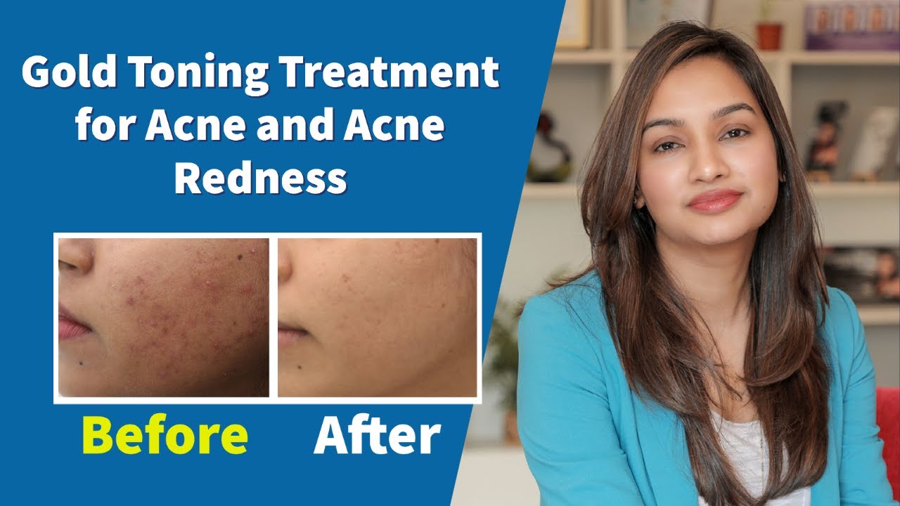 Gold (Laser) Toning Treatment for Acne and Acne Redness | Dr. Jyoti ...