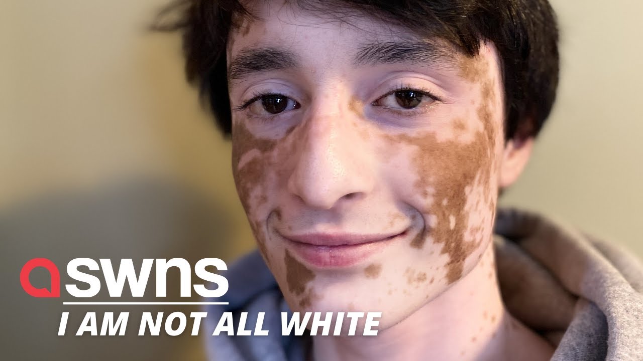 Teen with vitiligo shares his story after being accused of "cultural ...