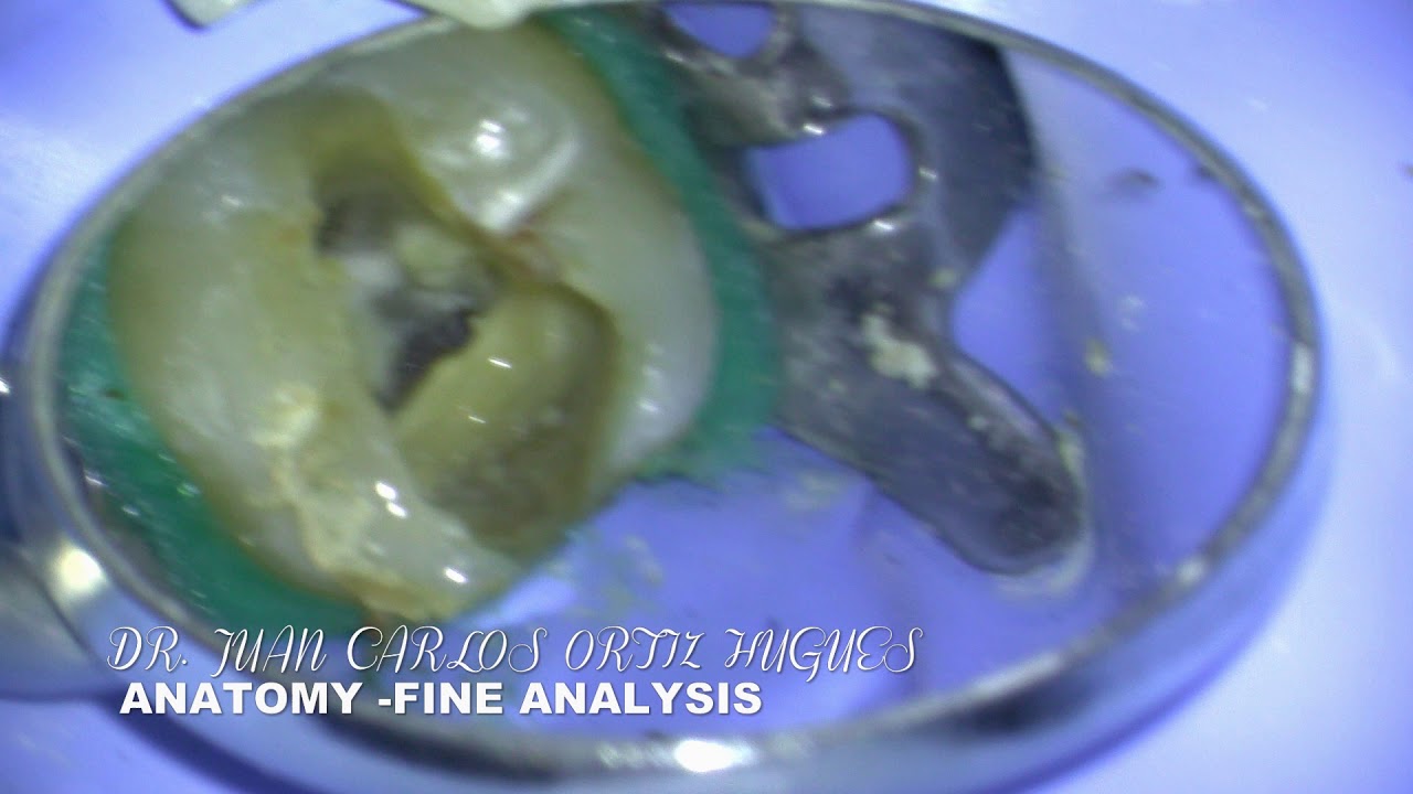 MICROSCOPE ENDODONTIC BENEFITS - YouTube