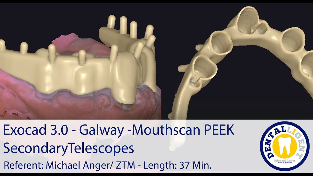 2021-Exocad - Tutorial Preview-Exocad 3.0 – Galway Mouthscan PEEK ...