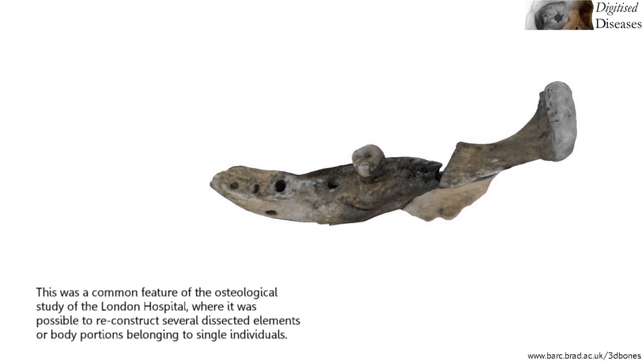 A sawn jaw bone from the Royal London Hospital - YouTube