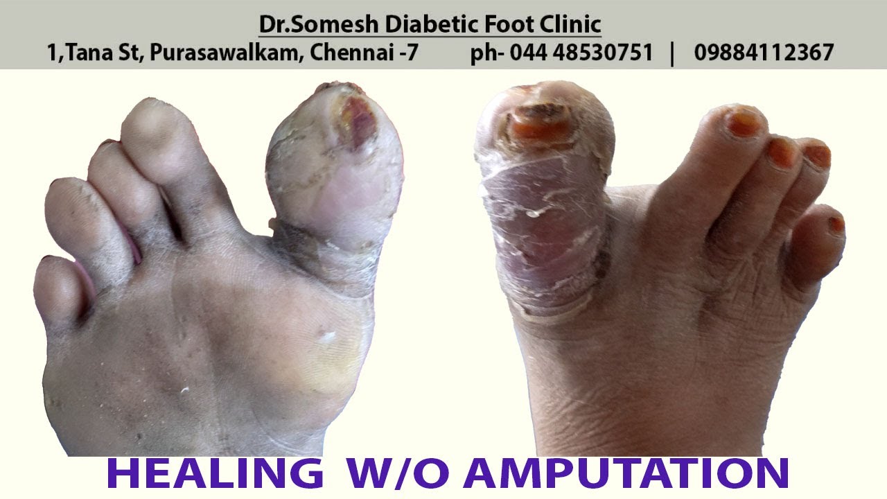 GREAT TOE TROPHIC ULCER INFECTION befoe after video - YouTube