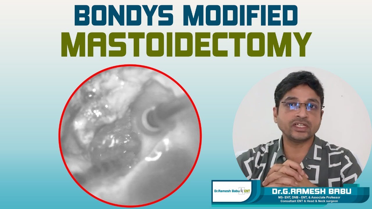 BONDYS MODIFIED MASTOIDECTOMY || Dr Ramesh Babu ENT - YouTube