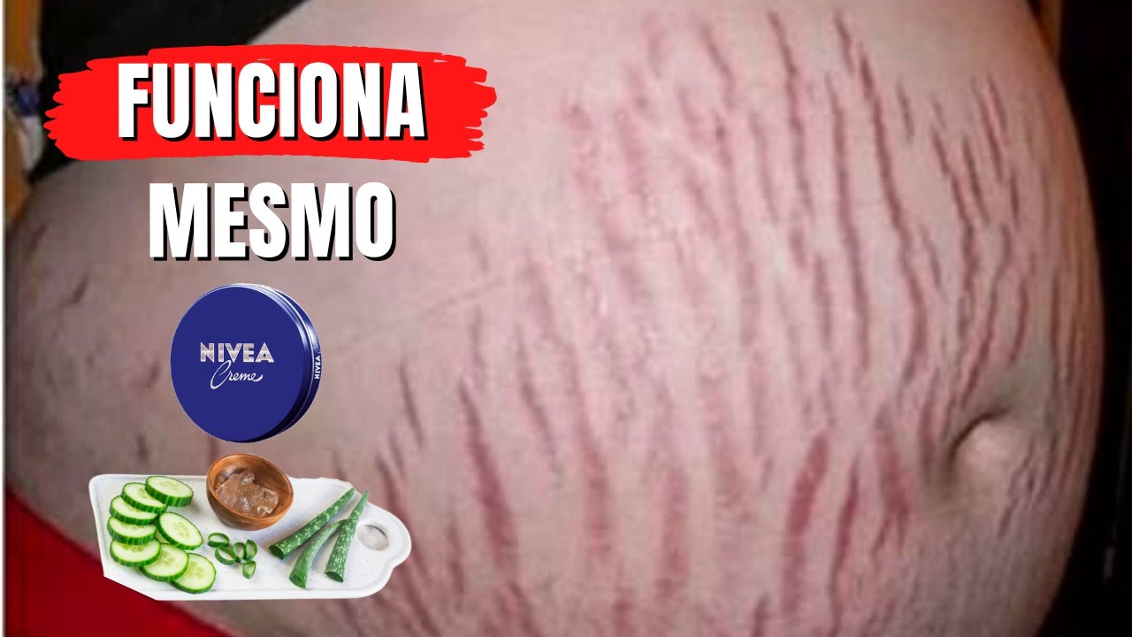 Tratamento Para Estria Vermelha - Receitas Caseiras - YouTube