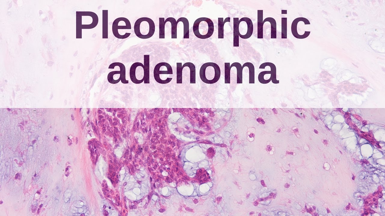 Pleomorphic Adenoma of Salivary Gland - YouTube