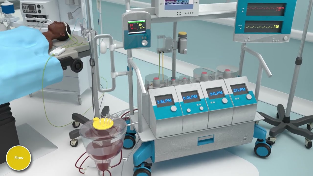 Cardiopulmonary Bypass and ForeSight Cerebral Tissue Oximetry - YouTube