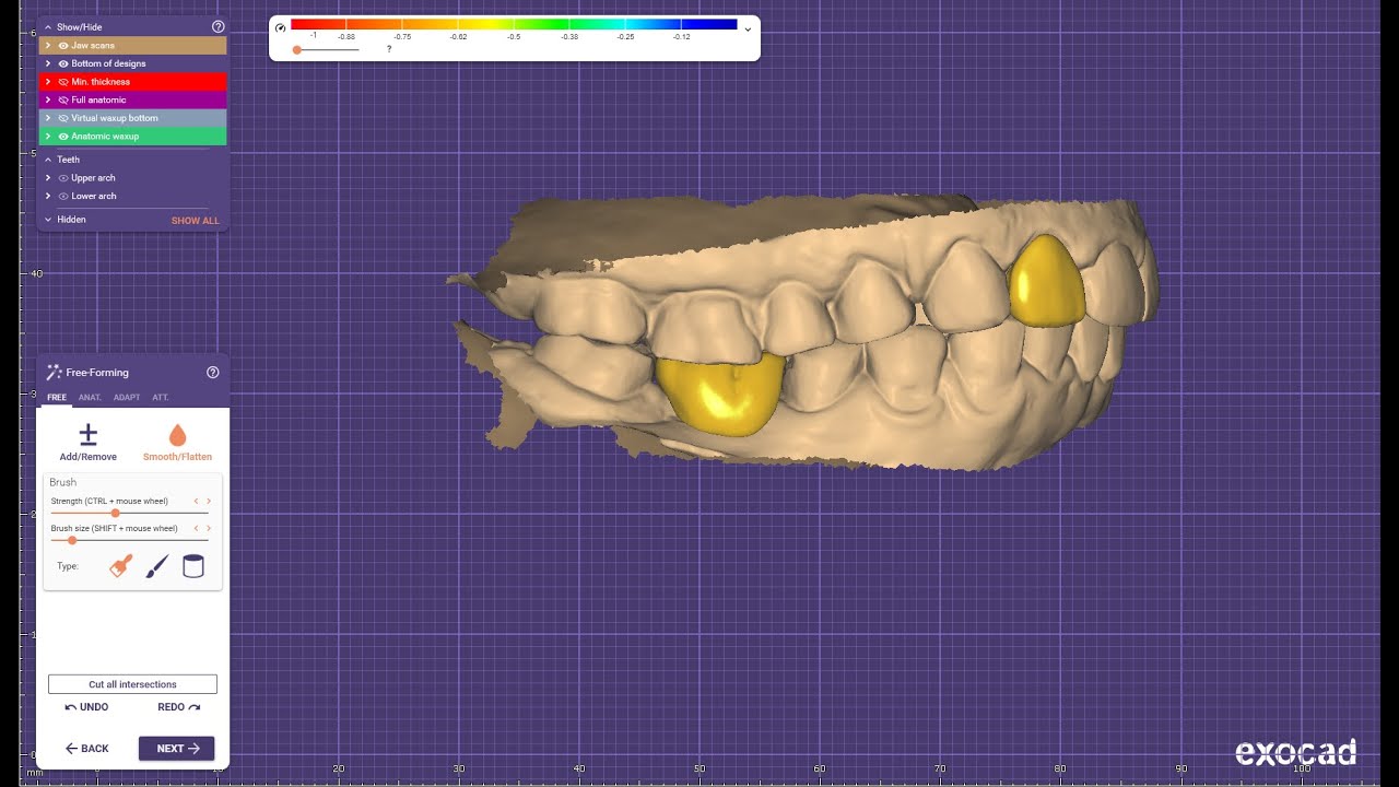 How to design Upper right lateral and lower molar designing in exocad ...