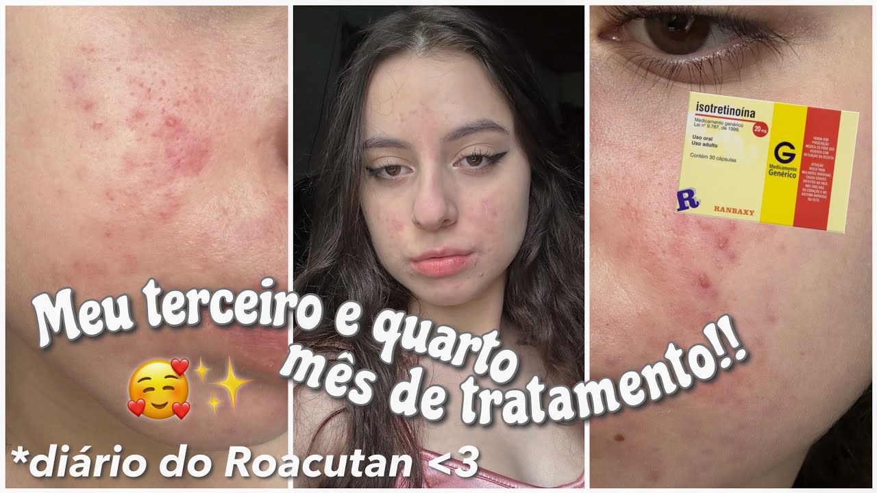 DIÁRIO DO ROACUTAN!💕 |terceiro e quarto mês de tratamento - YouTube