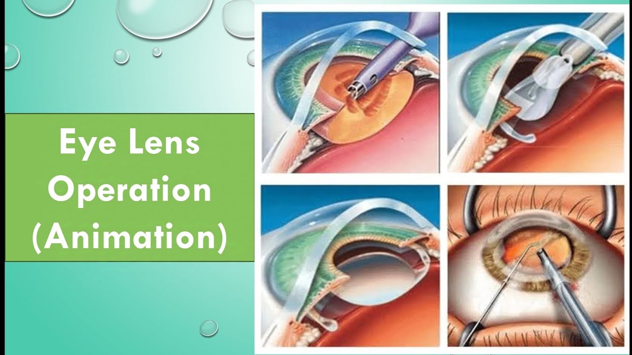 How to treat human eye lens animation - YouTube