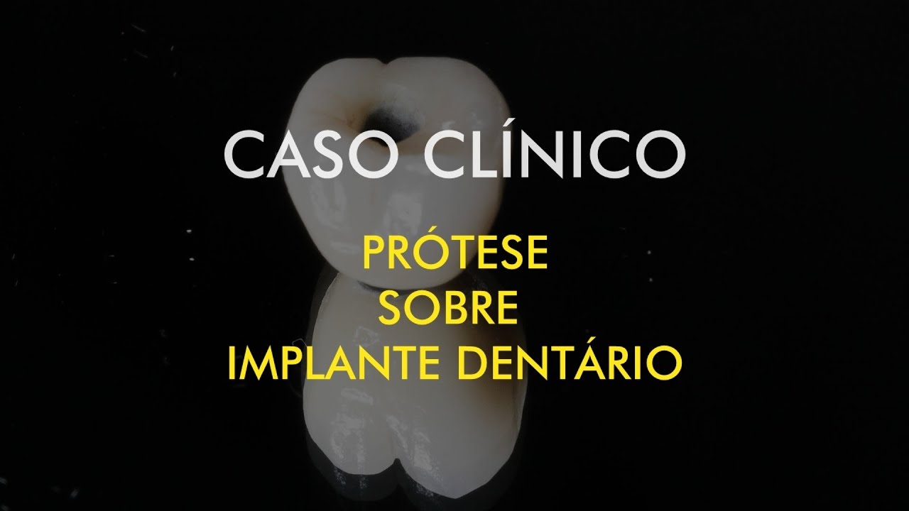 Prótese Unitária Fixa sobre Implante Dentário • Dr. Luis Drummond ...