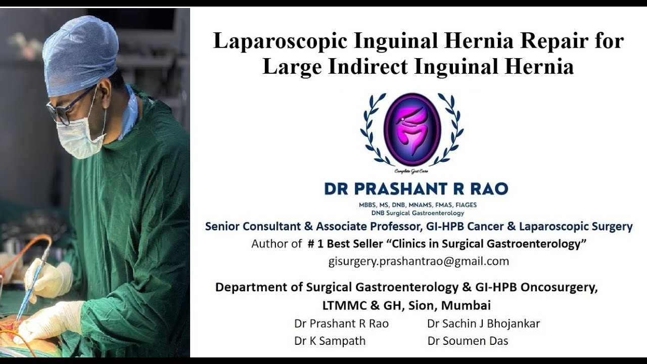 Laparoscopic TAPP Repair for Large Indirect Inguinal Hernia | Real-Time ...