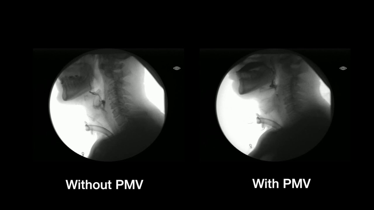 Videofluoroscopy with and without Passy Muir Valve - YouTube