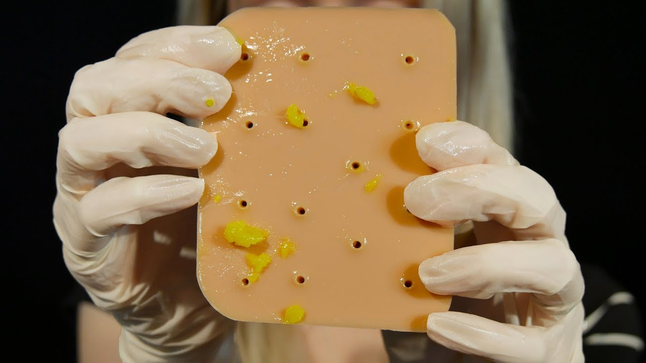 Satisfying ASMR | Pimple Popping & Squeezing - YouTube