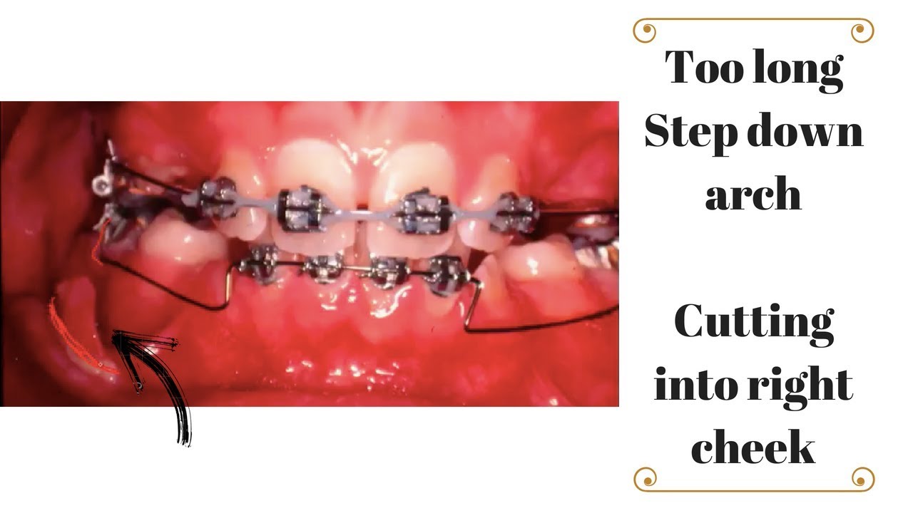 Understanding the Step down arch - YouTube