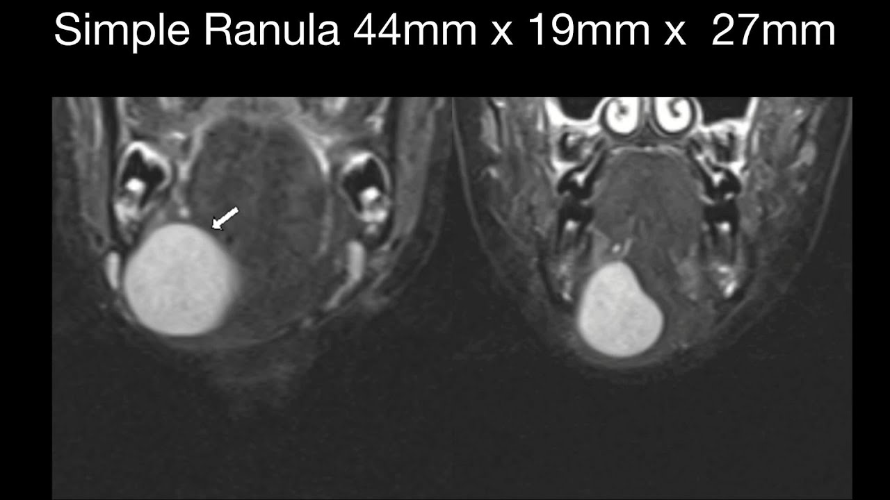 Simple Ranula - YouTube