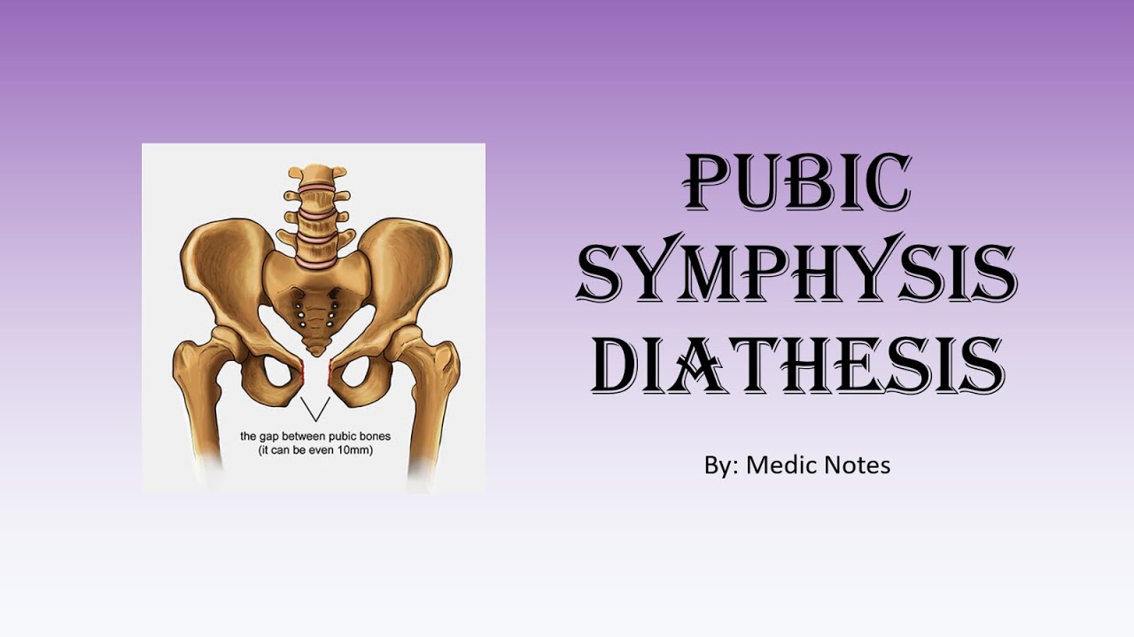 Pubic symphysis diathesis - causes, imaging findings, treatment - YouTube